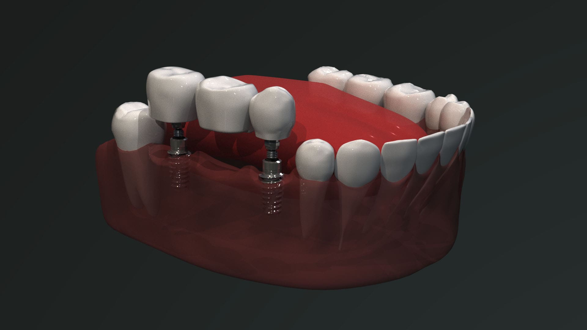 Dantų implantacija - A. Mackevičiaus odontologijos klinika - Vilnius