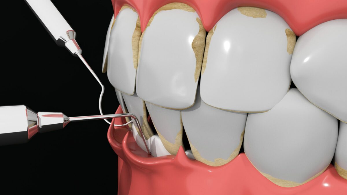 Periodontologinis gydymas - A. Mackevičiaus odontologijos klinika - Vilnius