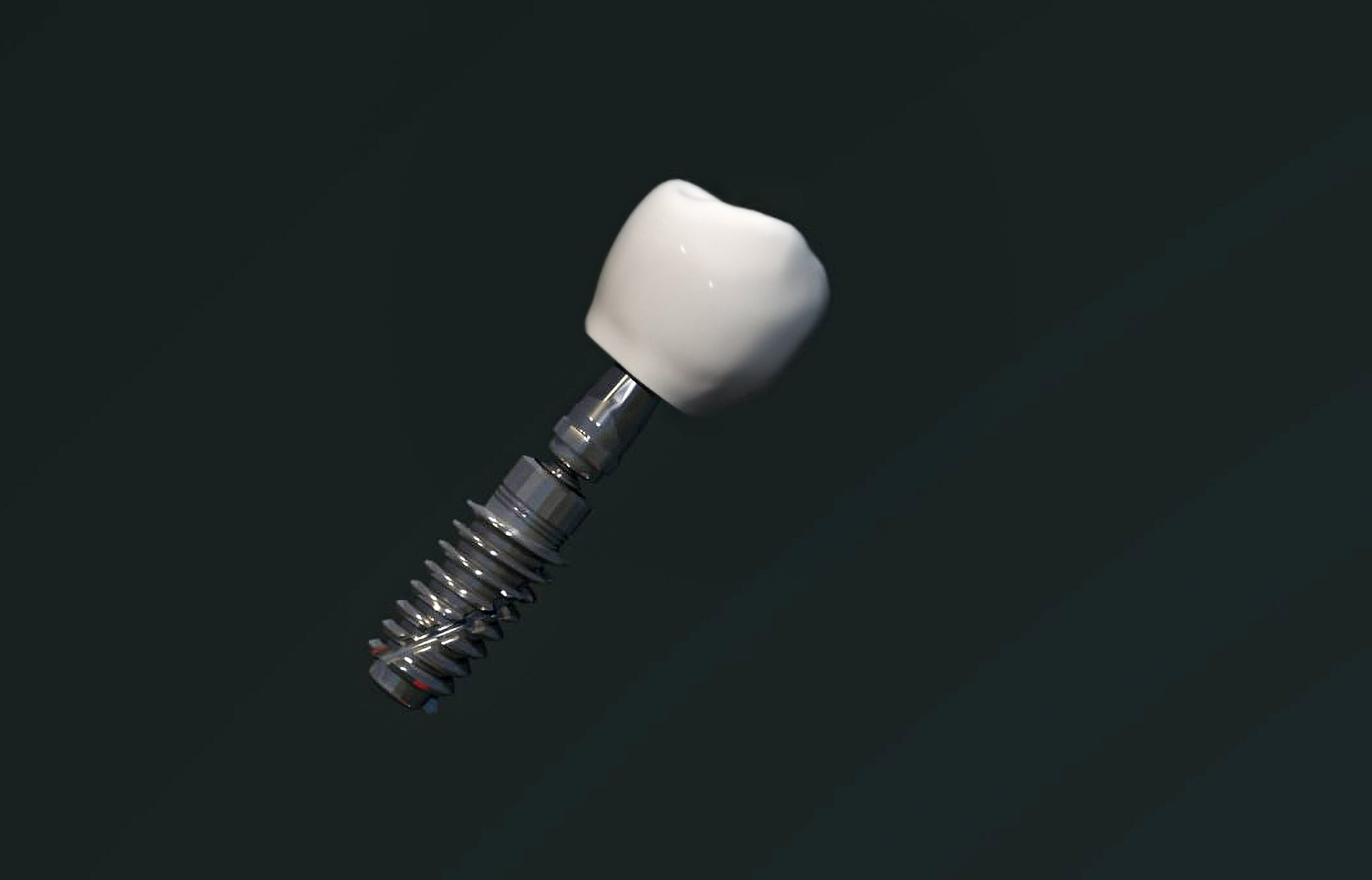 „Straumann“ implants - A. Mackevičiaus odontologijos klinika - Vilnius